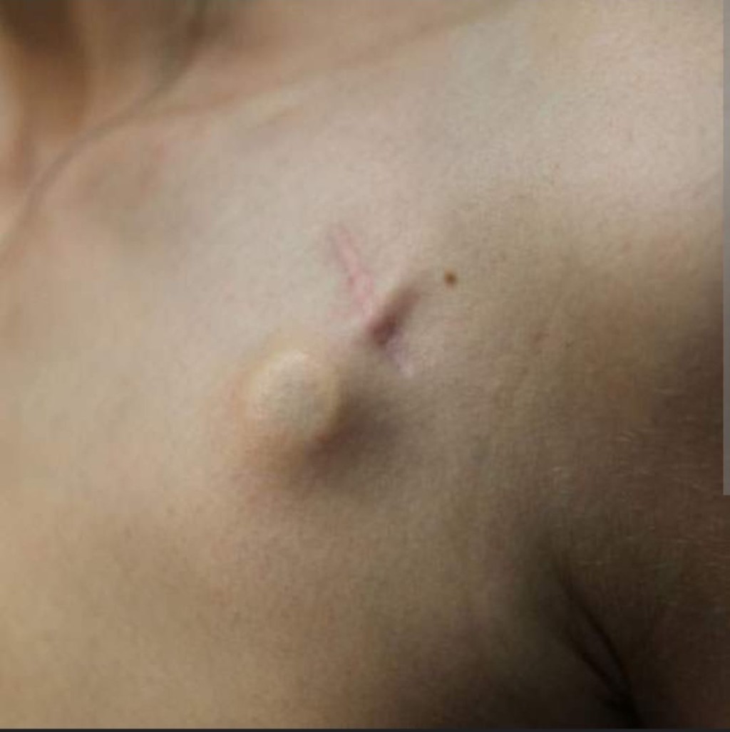 Tout savoir sur la chambre implantable : fonctionnement, pose, et ...